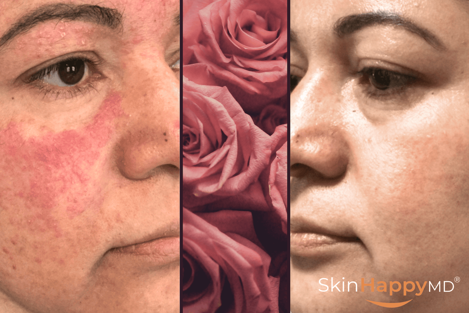 Rosacea Reframed: How Knowledge Transforms Care – SkinHappy Clinic